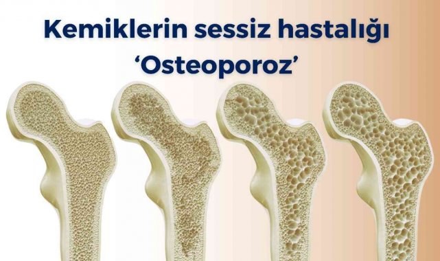 Kemiklerin sessiz hastalığı olarak bilinen 'osteoporoz' yani kemik ...